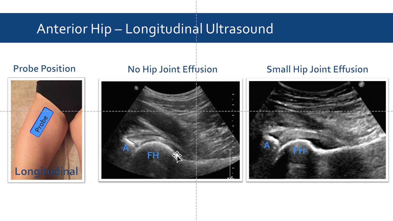 Ultrasound Guided Hip Joint Fluid Aspiration And Ster