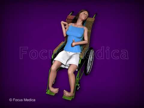 Spasticity - Animated Atlas