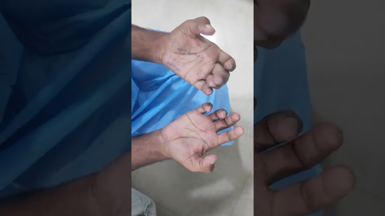 Grip and Release Test - Cervical Myelopathy - YouTube