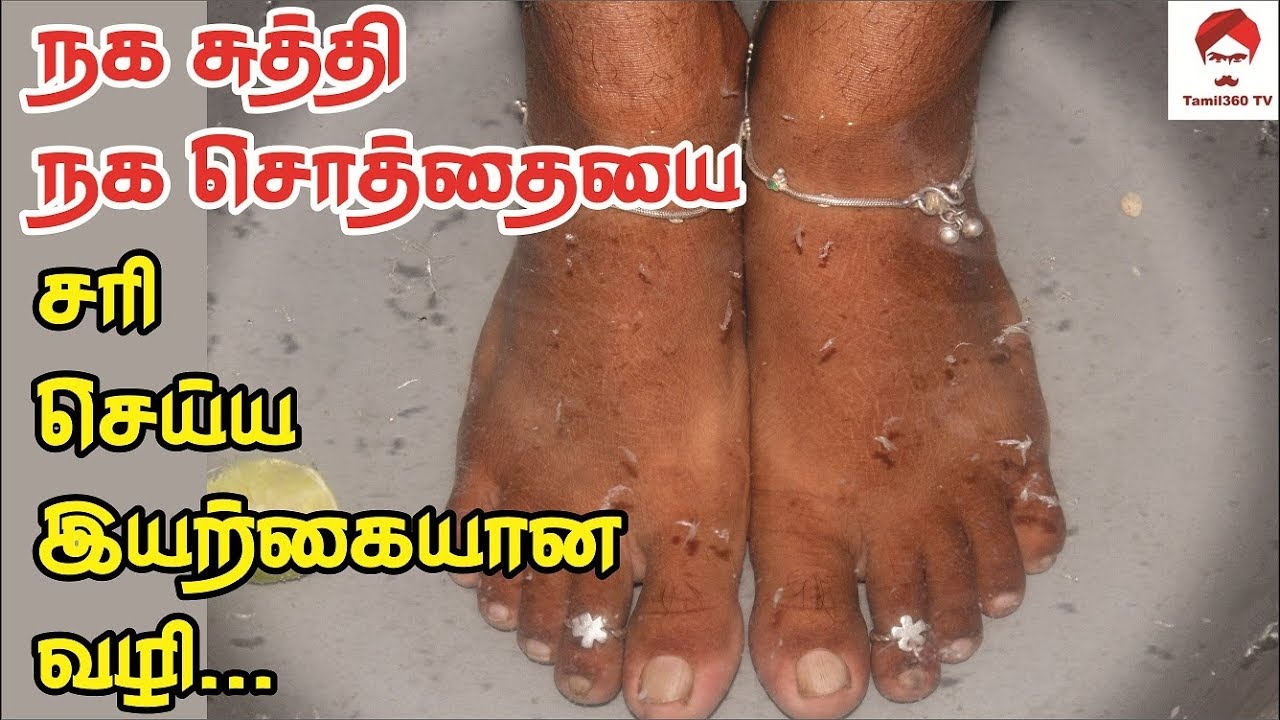 நக சுத்தி, நக சொத்தையை சரி செய்ய இயற்கையான வழி || How to Cure Nail ...