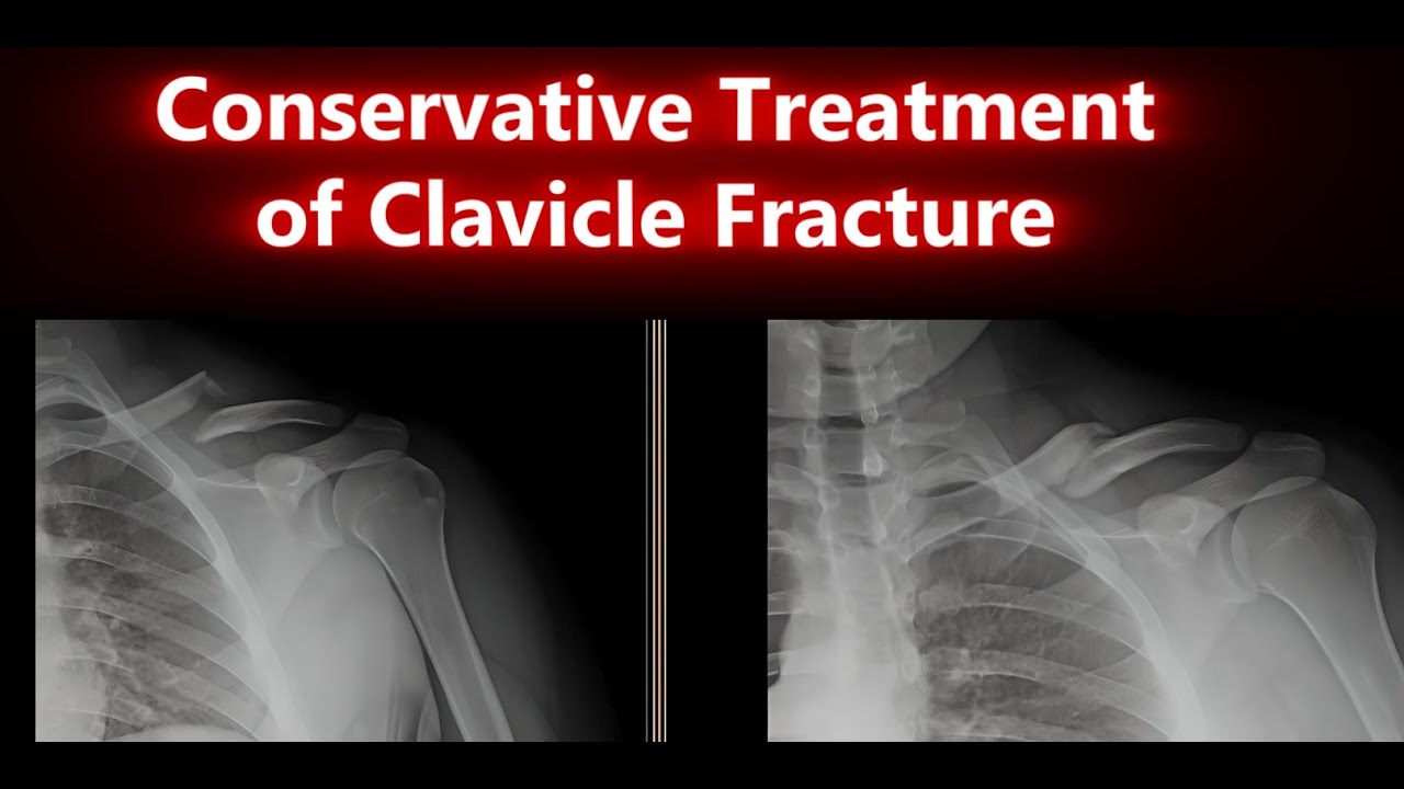 Conservative Treatment of Clavicle Fracture - YouTube