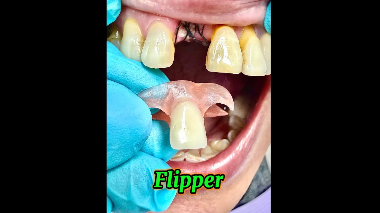 Exctraction and Replacement of the missing tooth with the Flipper ...
