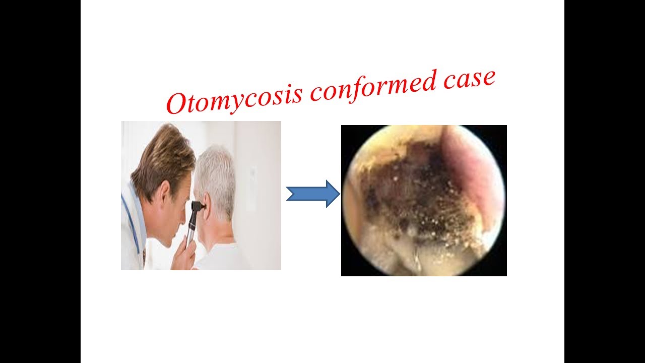 Otomycosis conformed case- KOH preparation-Positive - YouTube