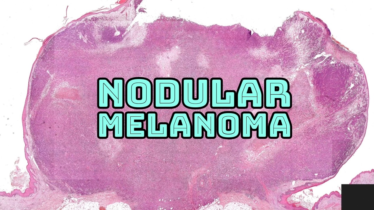Nodular Melanoma with satellite lesion (pathology dermpath dermatology ...