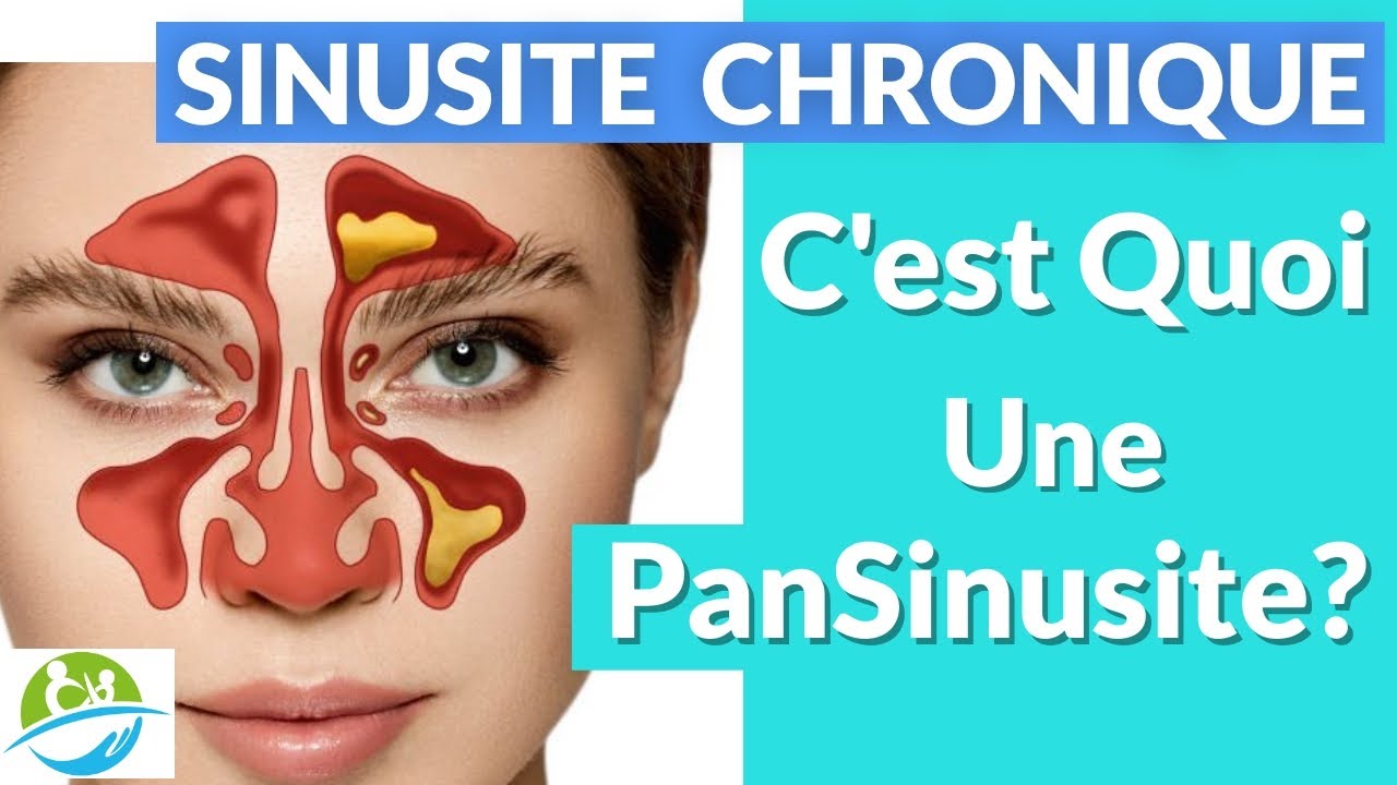 SINUSITE CHRONIQUE: C'est Quoi une PanSinusite? - YouTube