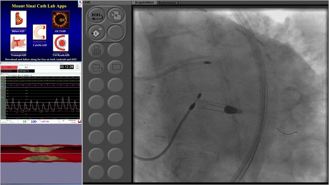 LC #2 - Impella assisted LM & OM1/LPL PCI - CCC 2019 - YouTube