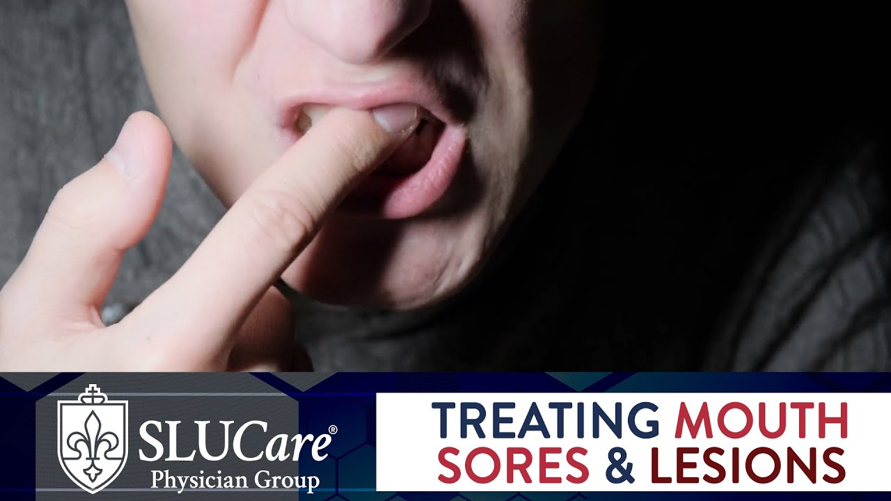 Mouth Sores & Lesions: Diagnosing and Treatment - SLUCare ...