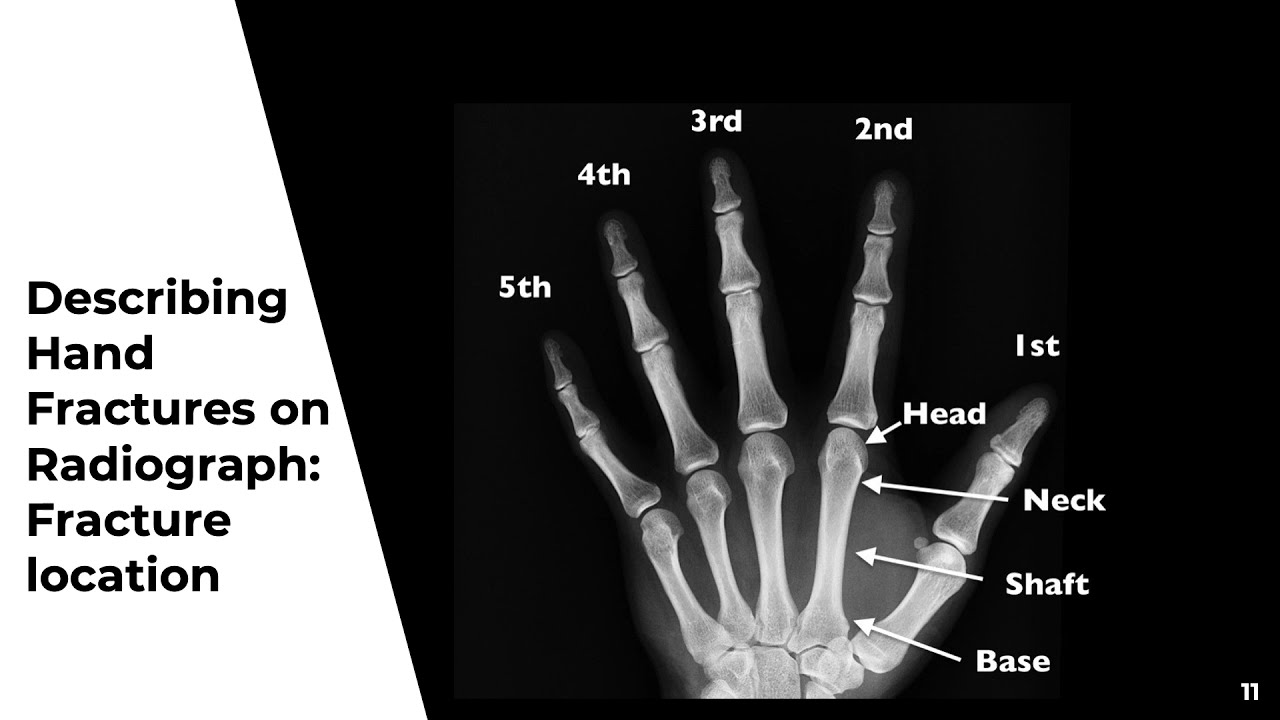 Hand - Describing Hand Fractures - YouTube