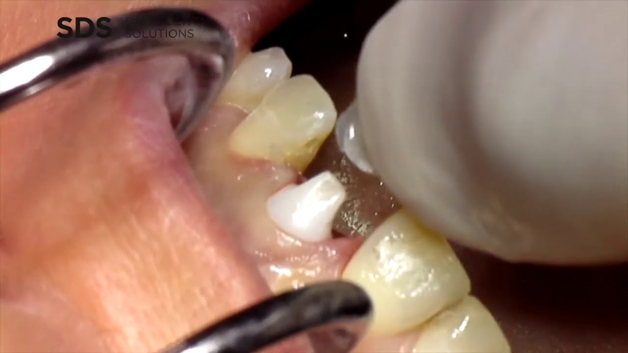 5 4 Langzeitprovisorium SDS1 1 - YouTube