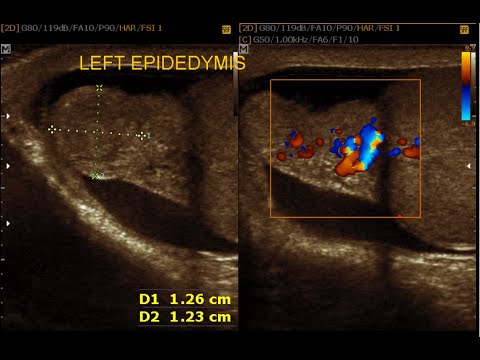Ultrasound cases 231 of 2000 || Left sided epididymitis with reactive ...