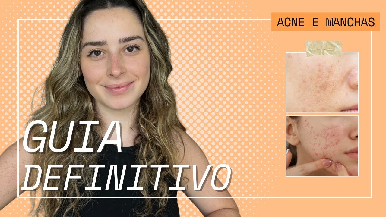 Pele com Acne e Manchas | 8 Dicas para Cuidar da sua Pele de maneira ...