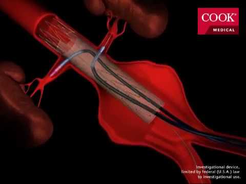 Fenestrated Endovascular Aneurysm Repair (FEVAR) Demonstrates Excellent ...
