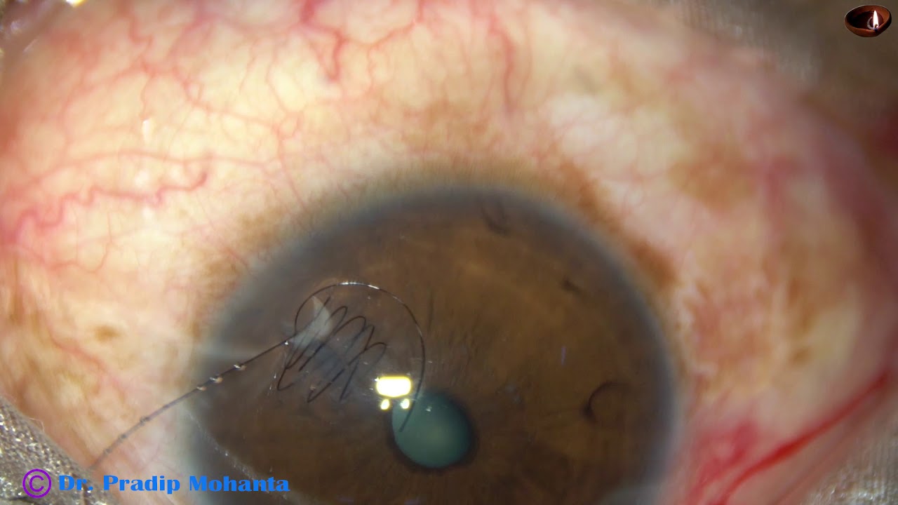 Repair of a corneal wound - Pradip Mohanta, 3rd May, 2019 - YouTube