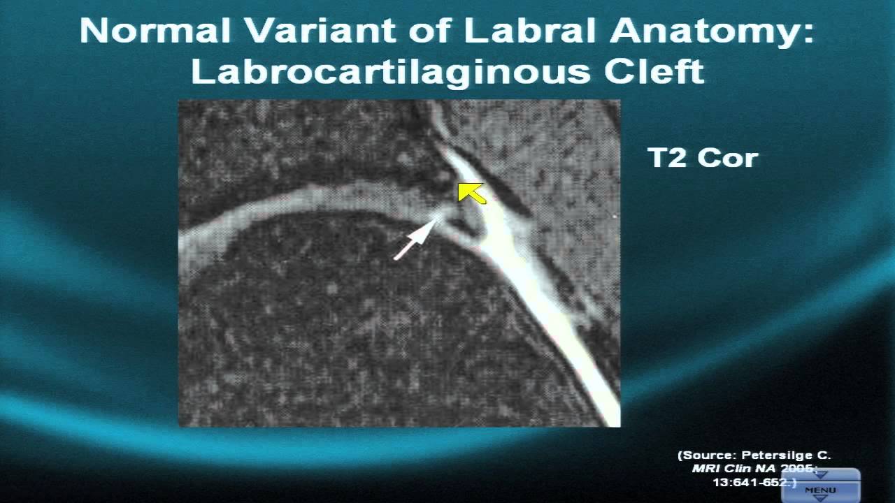 MRI Online: Hip Imaging, Part XI - YouTube