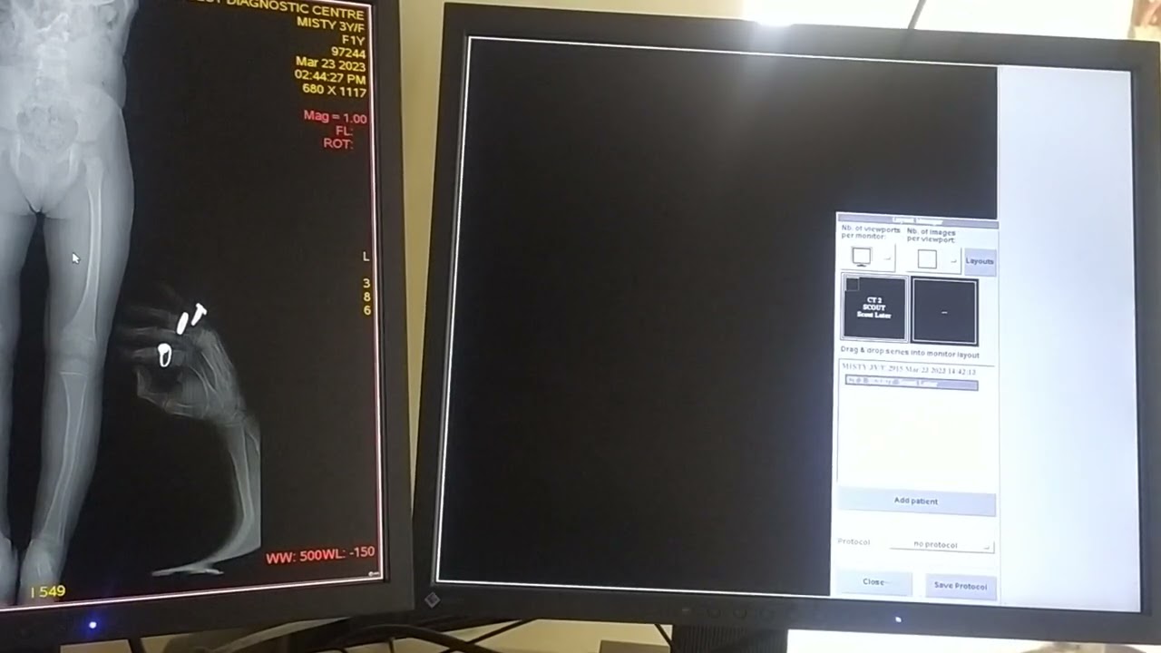 Xray Scanogram Youtube Scanogram Both Lower Limb🏥 . . #xray_doctor
