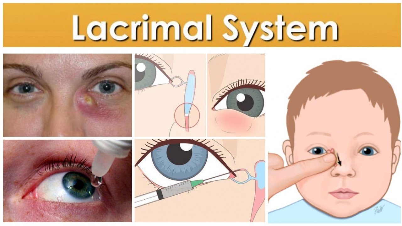 Lacrimal system 4(Last) Major Topic: Dry Eye Syndrome ...