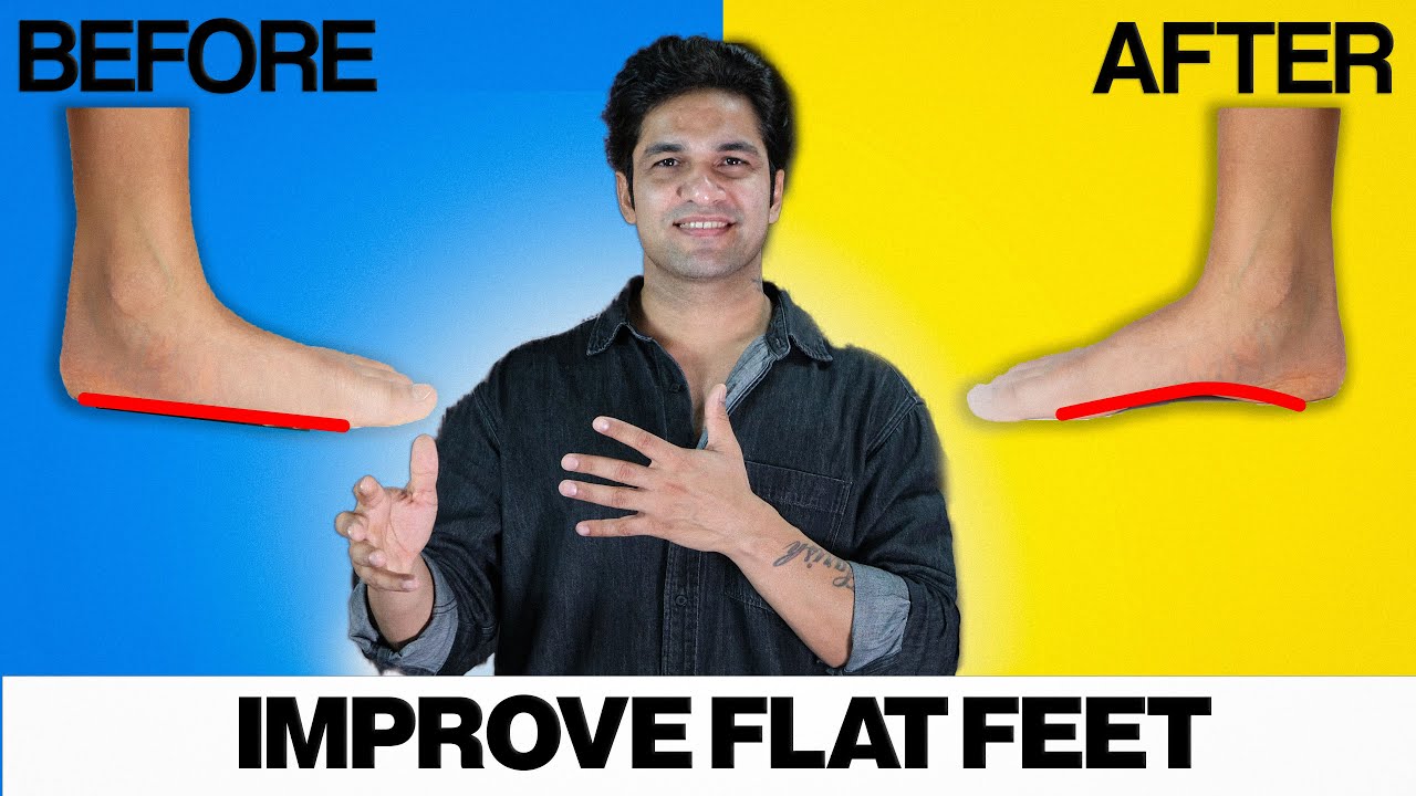 How to Fix Flat Feet at Home | Knee velgus Due to Flat Feet (Explained ...