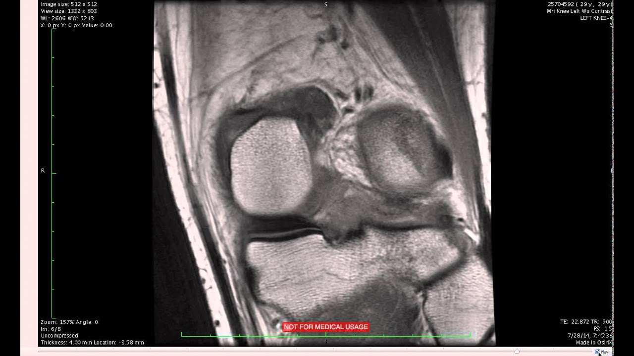 Knee MRI - COR T1 - YouTube