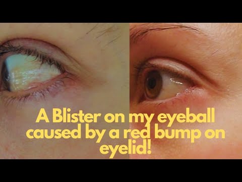 Blister// bubble on my eyeball caused by a red bump which I thought was ...