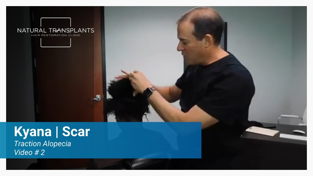 Fine Pencil Line Scar from Hair Transplant: Barely Noticeable! | Dr ...