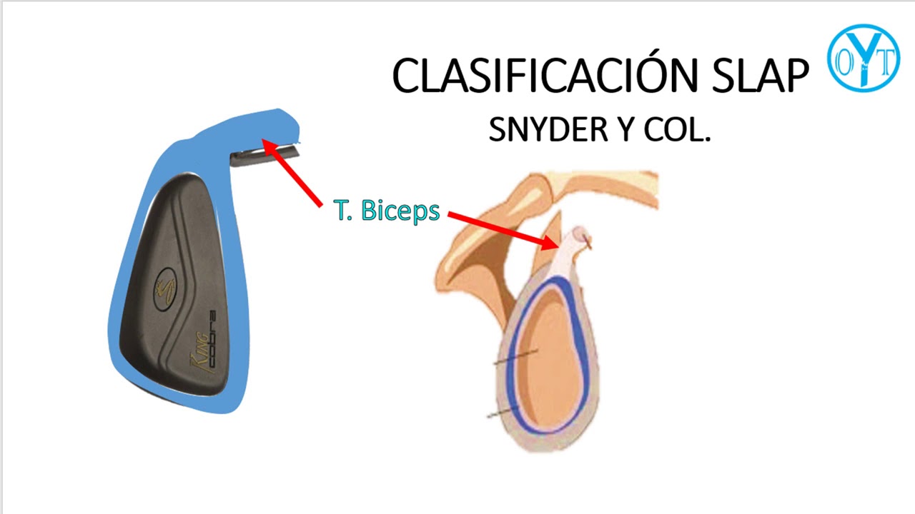 clasificación de la lesión de SLAP - YouTube