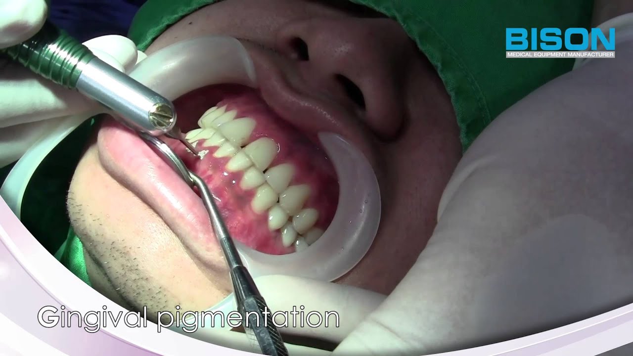 CYMA Dental Video (10600nm CO2 surgical laser) - Gingival Pigmentation ...