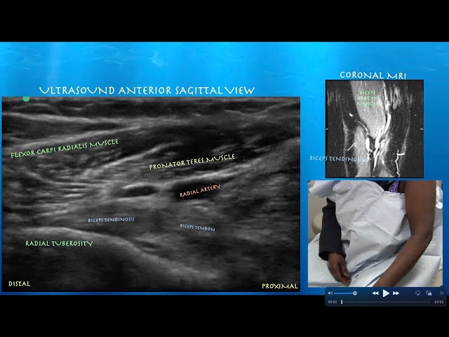 Distal Bicep Tendon Mri