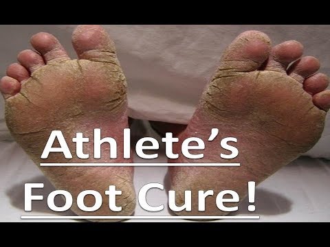 Athlete's Foot Fungus! [BEST Home Remedies] - YouTube