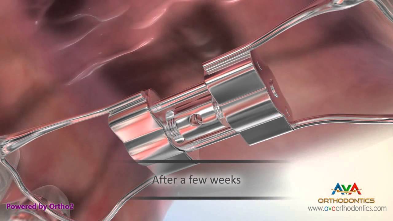 Rapid Palatal Expander RPE Hyrax - YouTube