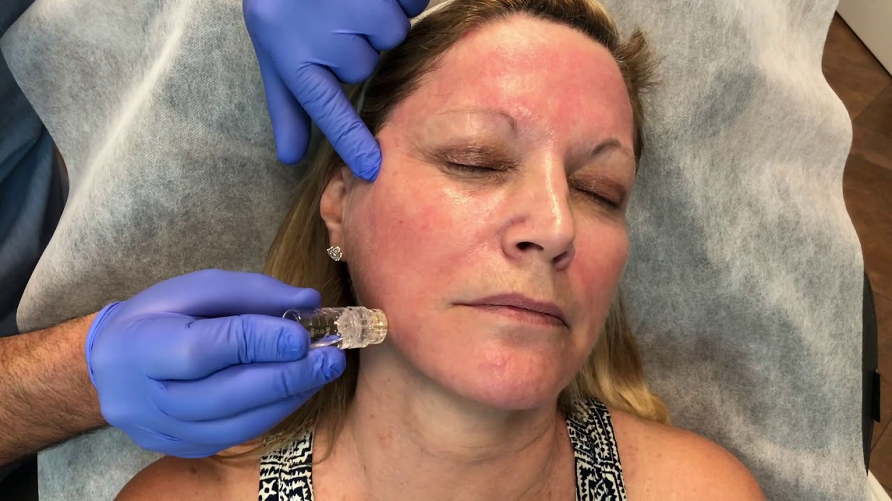 Meso Botox and Filler - Omeed Sani MD - Sani Aesthetics MD - YouTube