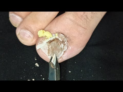 Thick and Wide Toenails: Insights into Onychomycosis (Dr. Saji Pedicure ...