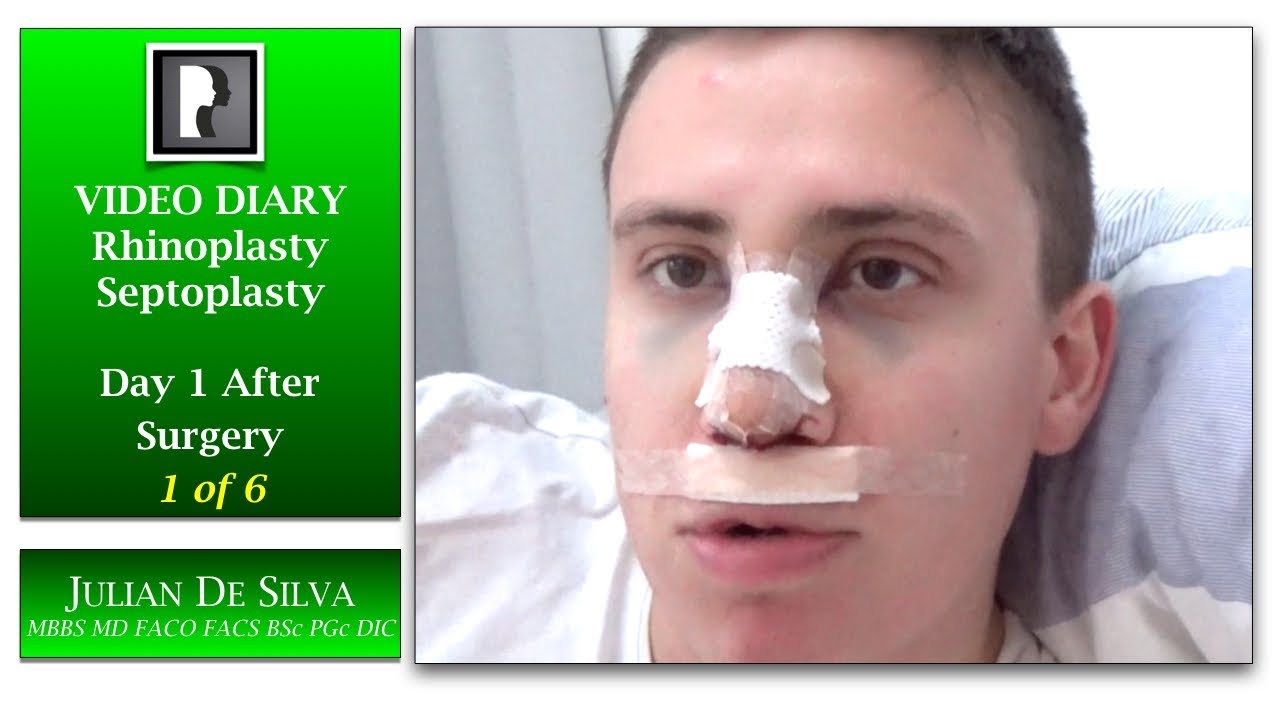 Male Rhinoplasty & Septoplasty Video Diary –Day 1 After Surgery, 1 of 6 ...
