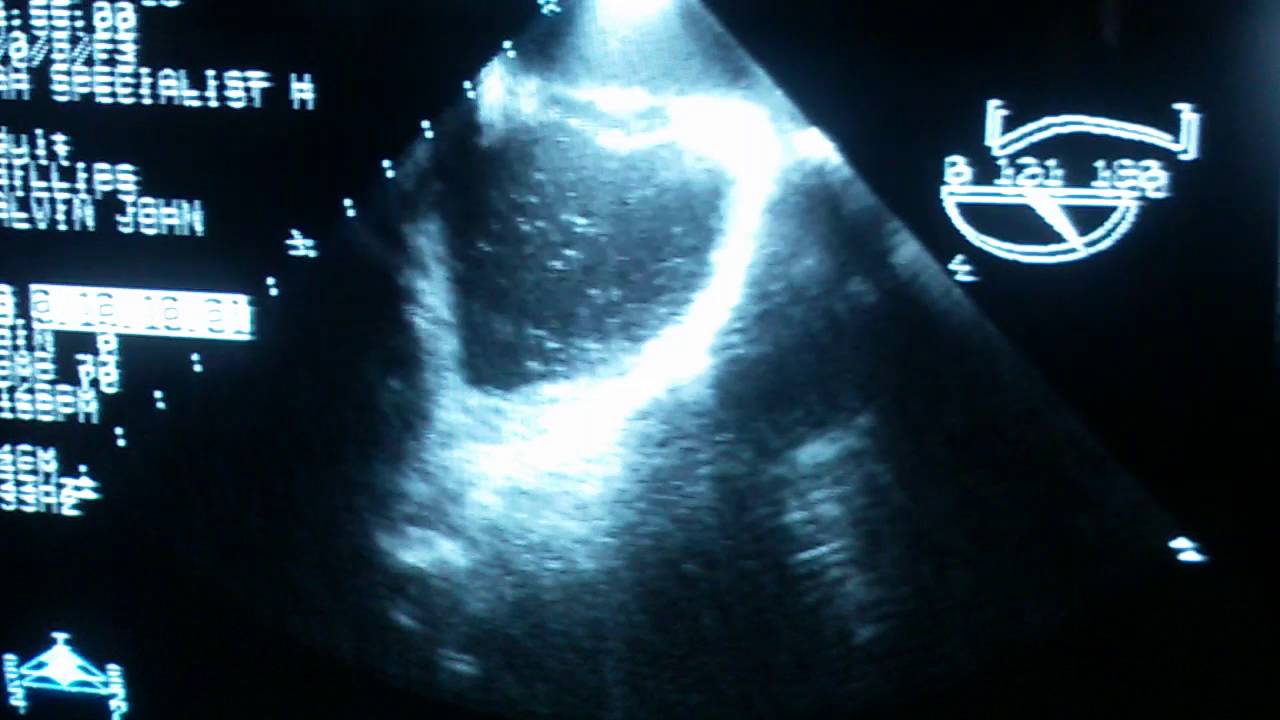 TEE bubble study to rule out pfo - YouTube