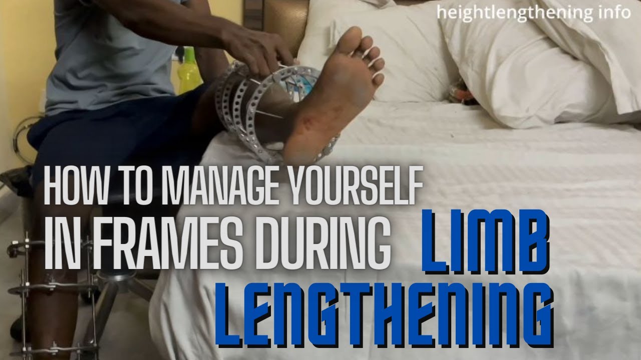 How to Manage yourself in Frames during Limb Lengthening Surgery ...
