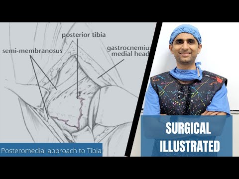 Modified Lobenhoffer approach to Isolated Posteromedial Tibial Plateau ...