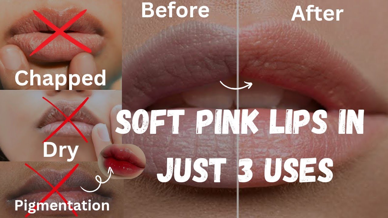 Get Rid of DARK DRY CHAPPED & PIGMENTED LIPS In Just 3 Days | Get PINK ...