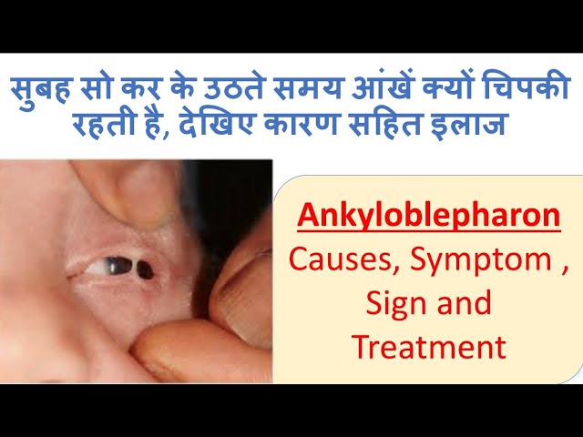 Ankyloblepharon