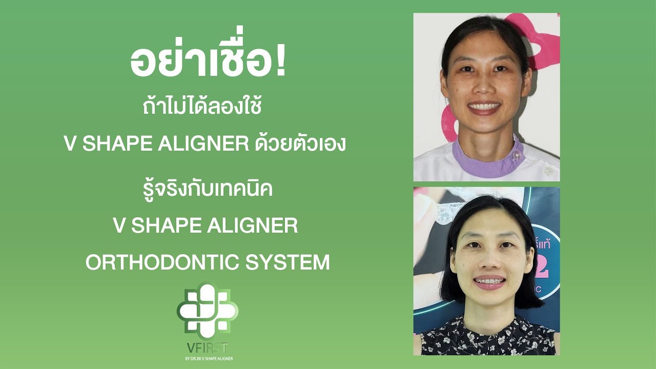 อย่าเชื่อถ้าไม่ได้ลองใช้ #vshapealignerด้วยตัวเอง รู้จริงกับเทคนิค #vshapealigner orthodontic ...