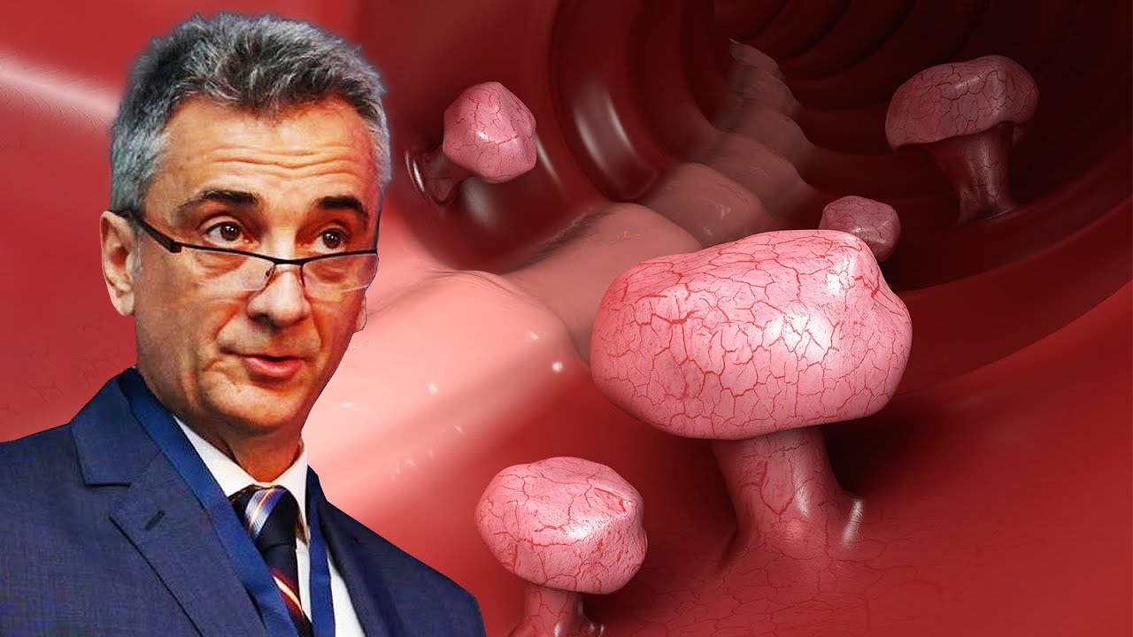 POLIPI NA DEBELOM CREVU: Kako se otkrivaju i kada ukazuju na karcinom ...
