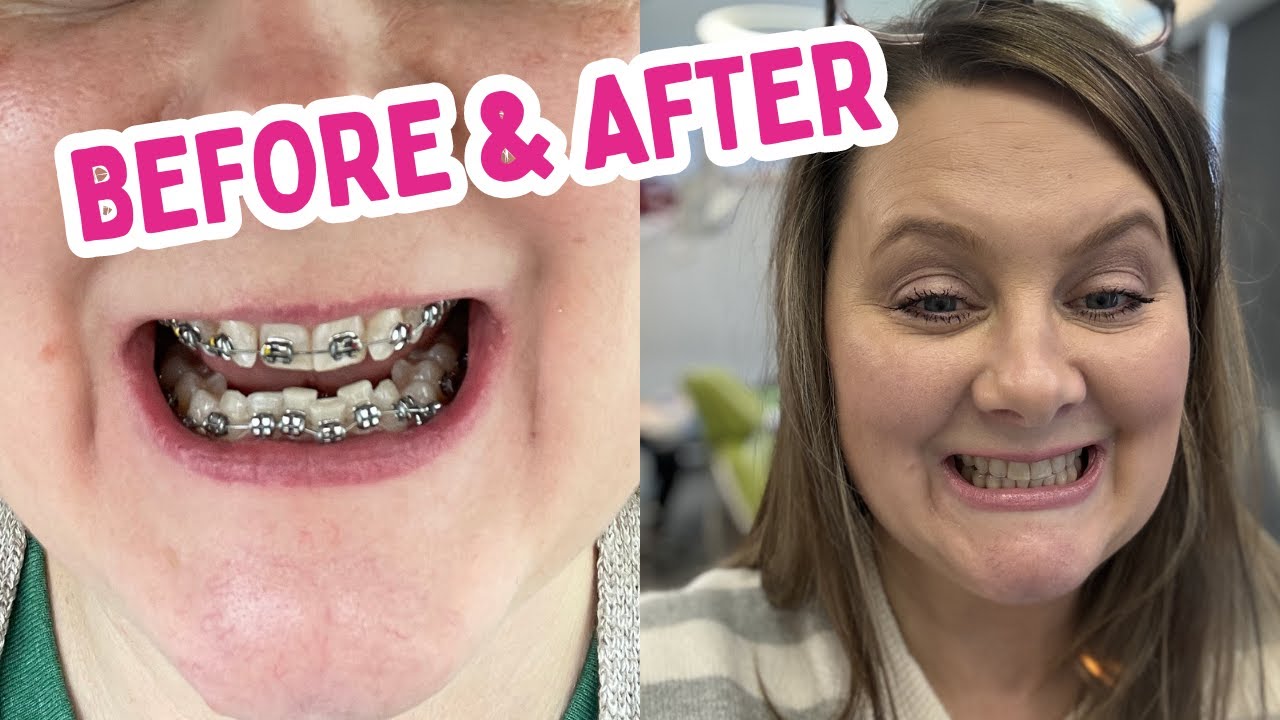 Mom Gets Braces Off | Before and After | Clear Retainers | Crystal ...