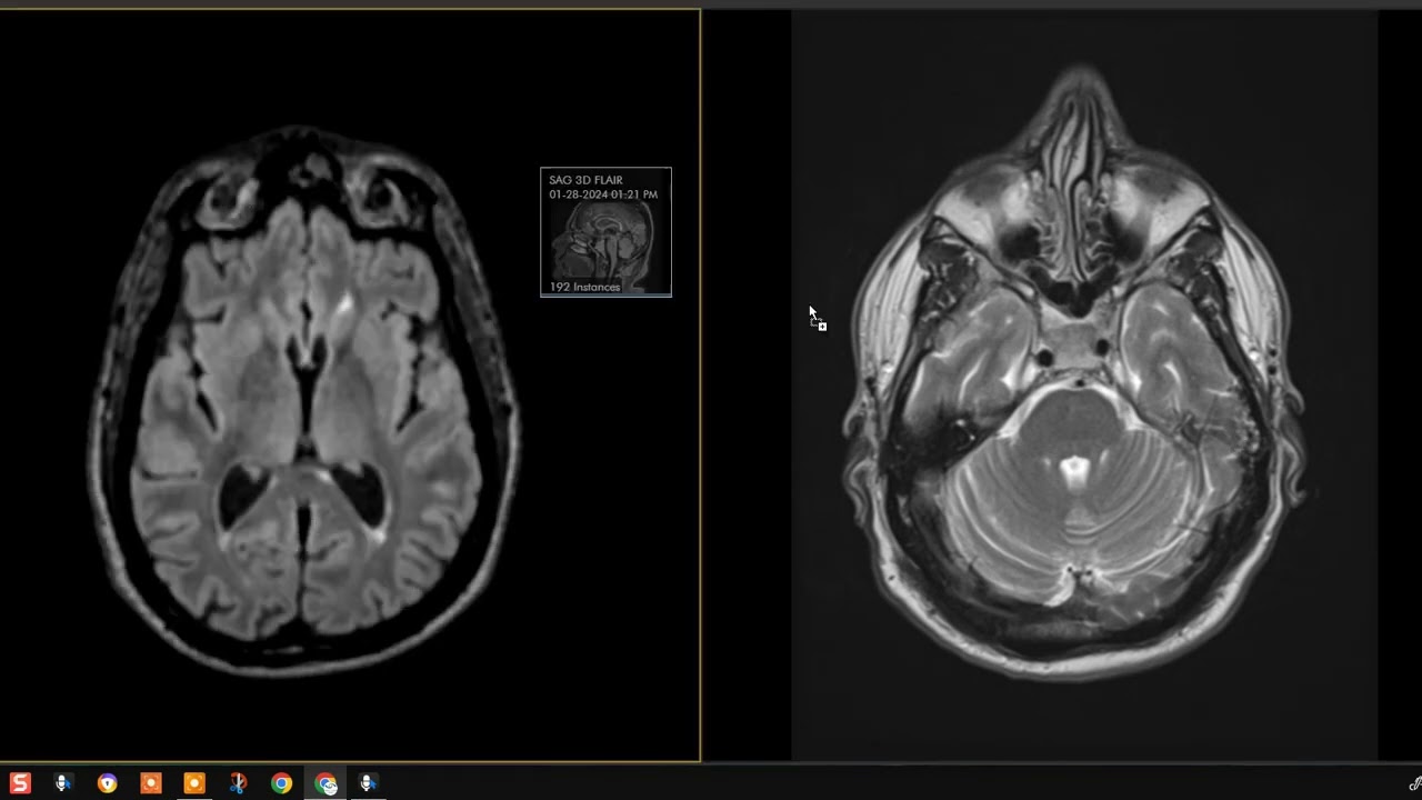 CT Scan of Ear: What to Expect, Why It's Done & What It Shows ...