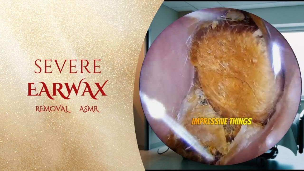 SEVERE EAR WAX REMOVAL, LOOKS LIKE A STONE #earwaxremoval #earwax # ...