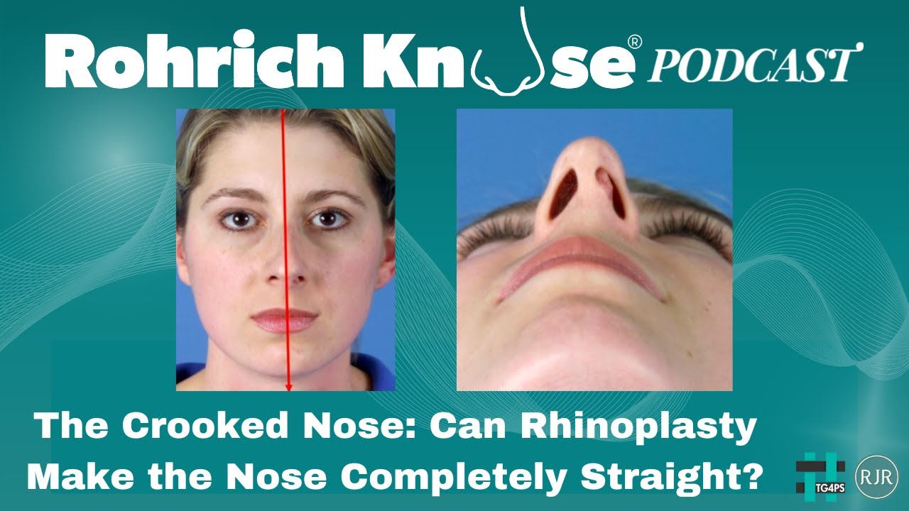 The Crooked Nose-Key to a straight nose is a straight Septum! - YouTube