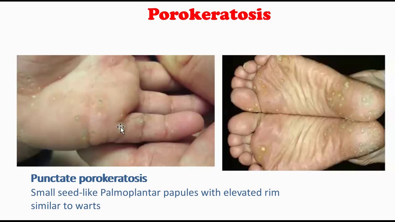 Porokeratosis - YouTube
