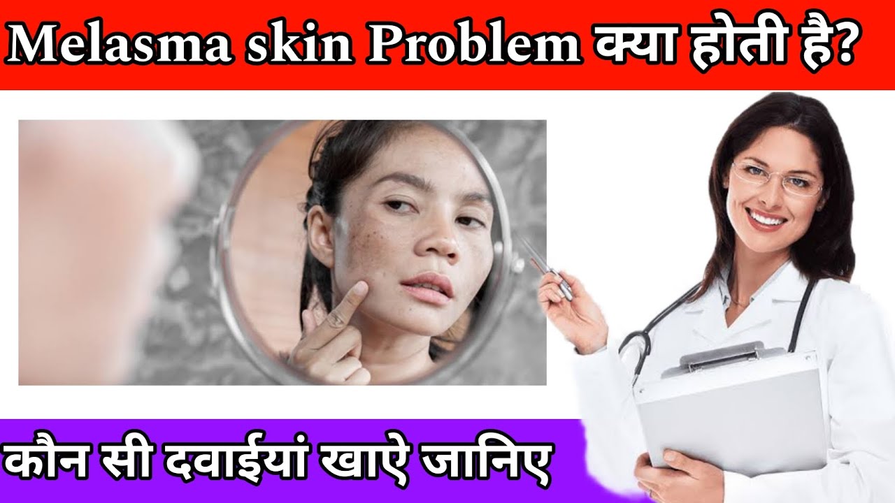 Melasma skin problem क्यों होती है और इसे ठीक कैसे करे? - YouTube
