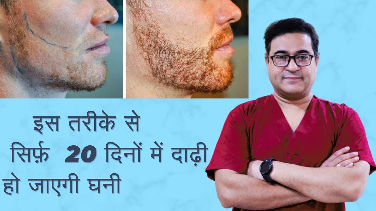 Amazing Beard Growth within 20 Days With NeoDhi Technique | Painless ...