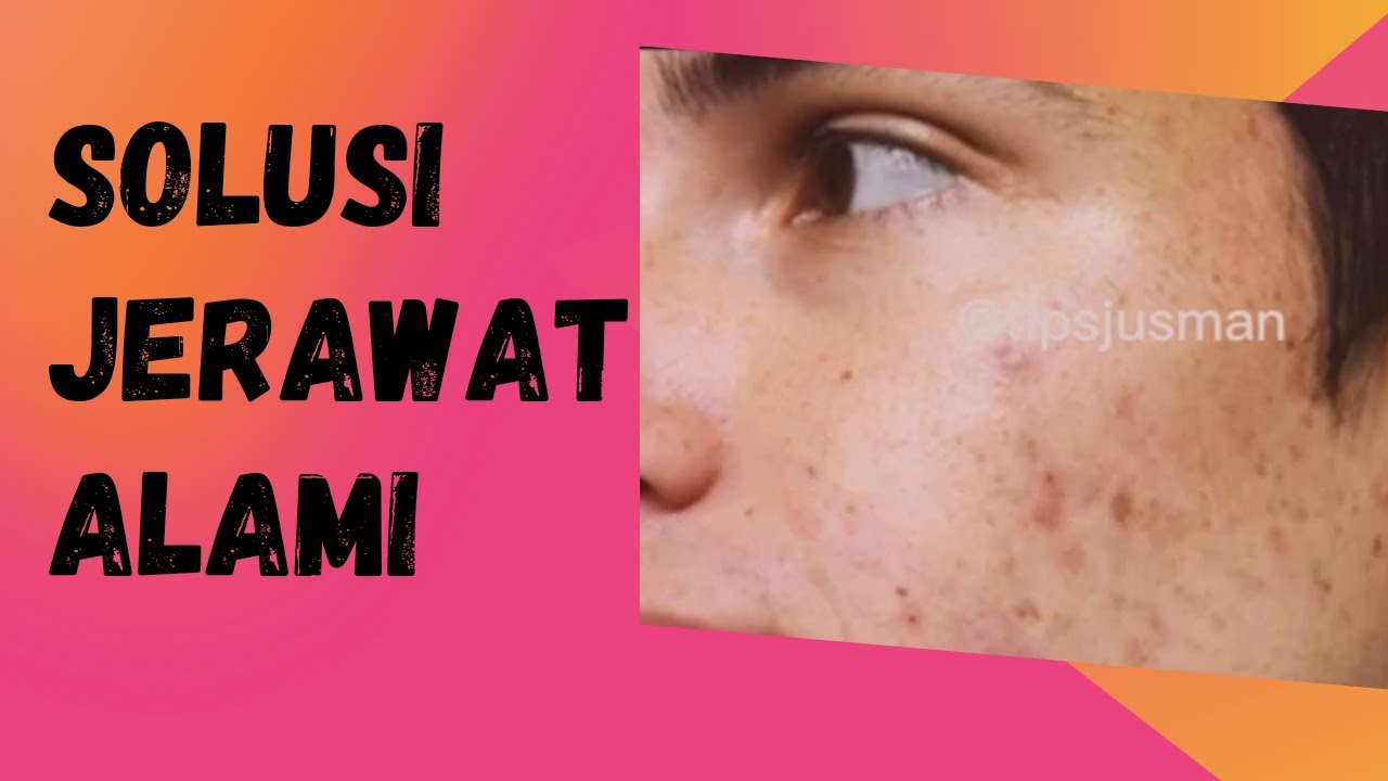 Cara Menghilangkan Jerawat Bruntusan Secara Alami dan Cepat dengan Madu dan Kayu Manis ? - YouTube