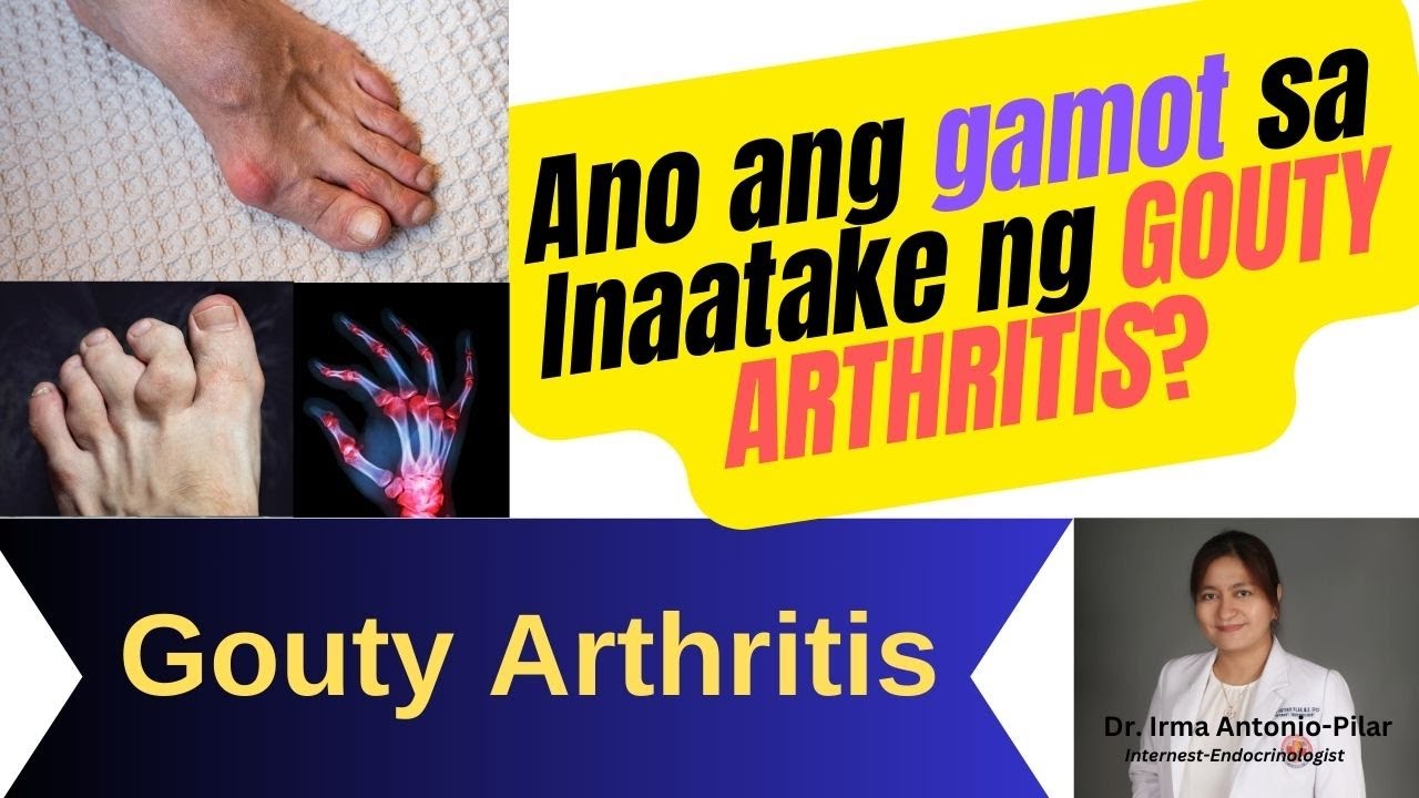 Ano ang gamot sa inaatake ng Gouty Arthritis? #gout #arthritis - YouTube