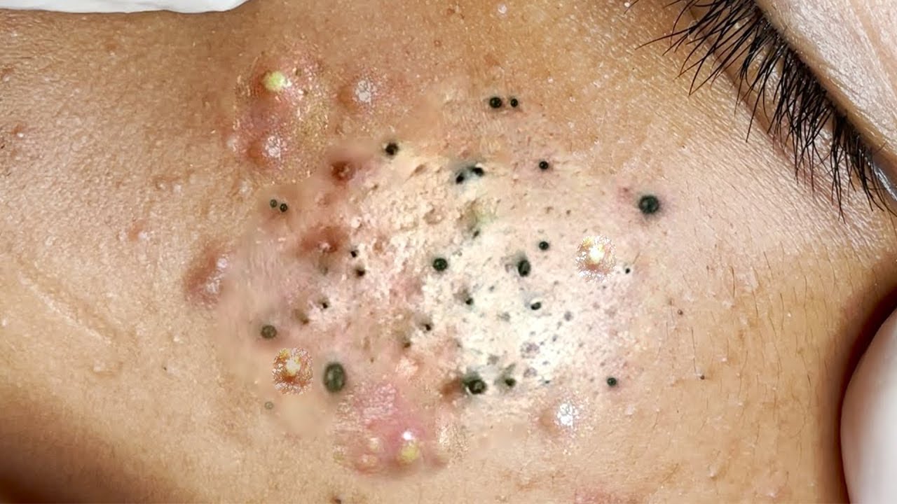 Big Cystic Acne Blackheads Extraction Blackheads & Milia, Whiteheads ...