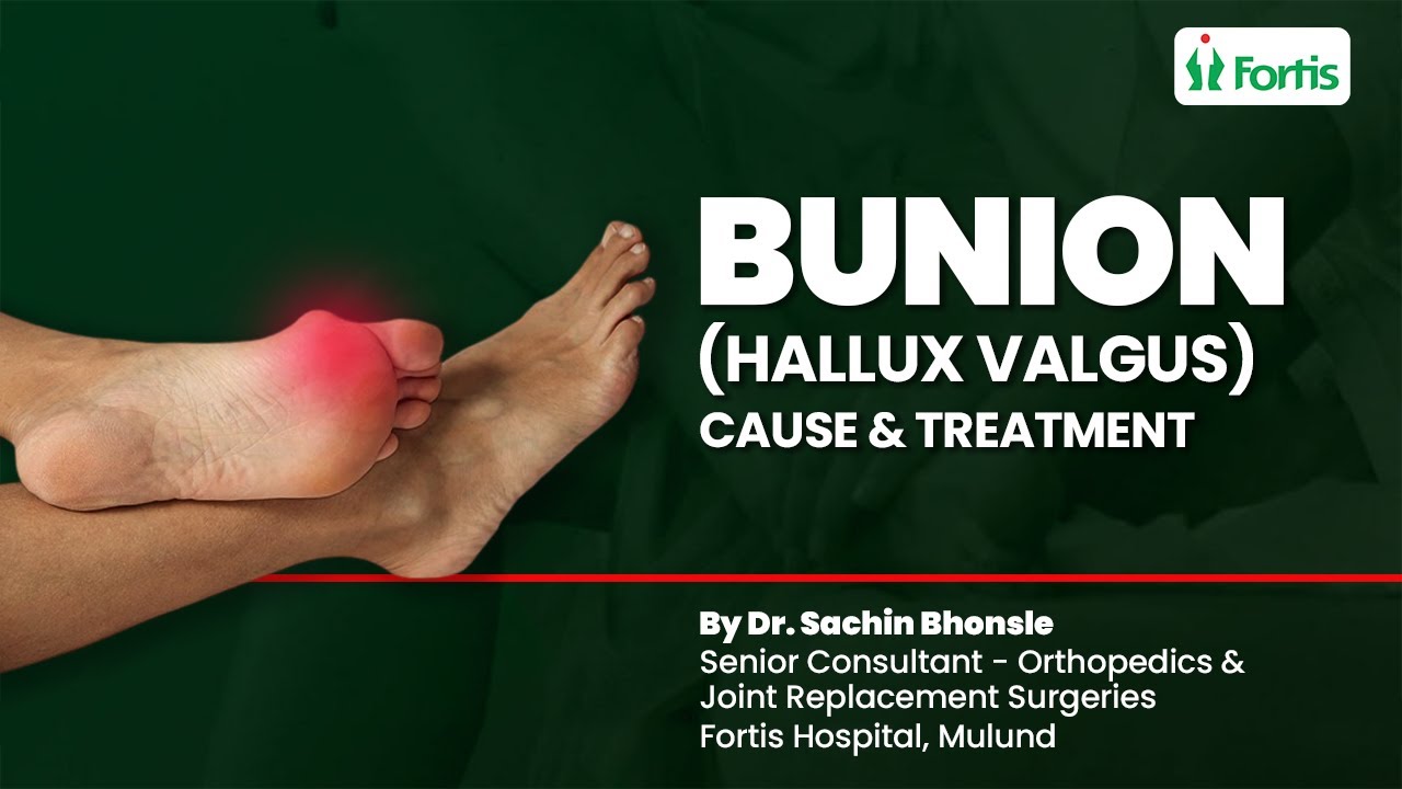 What Is The Main Cause Of Bunion (Hallux Valgus)? | Bunion Treatment ...